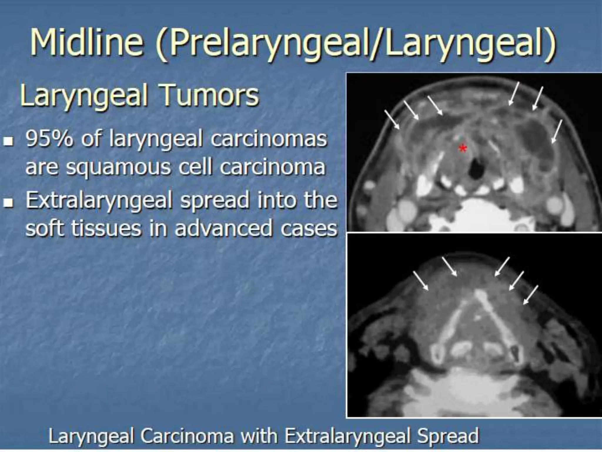 Presentation1.pptx, radiological imaging of adult neck masses. | PPTX