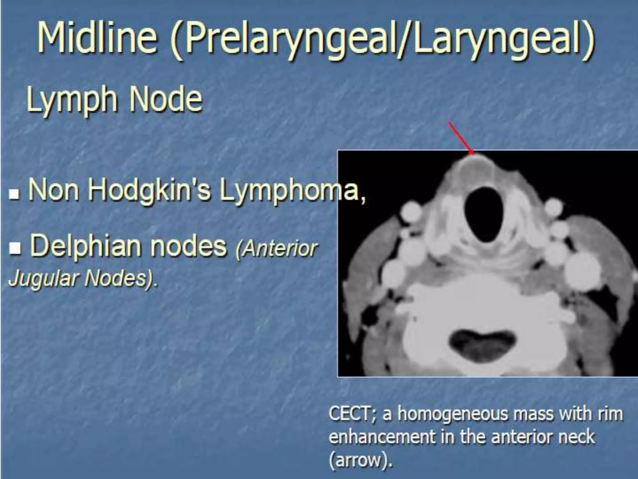 Presentation1.pptx, radiological imaging of adult neck masses. | PPTX
