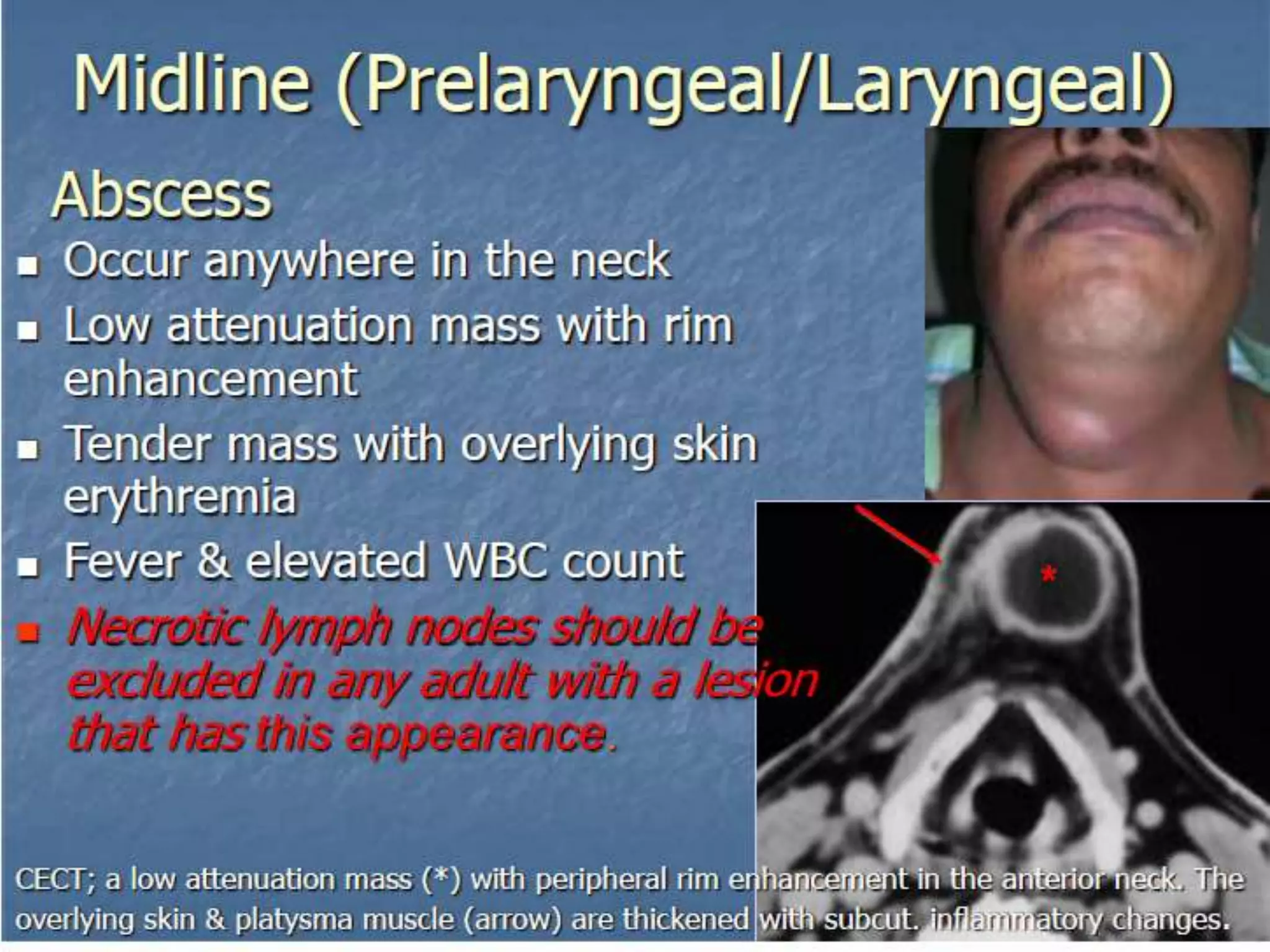 Presentation1.pptx, radiological imaging of adult neck masses. | PPTX