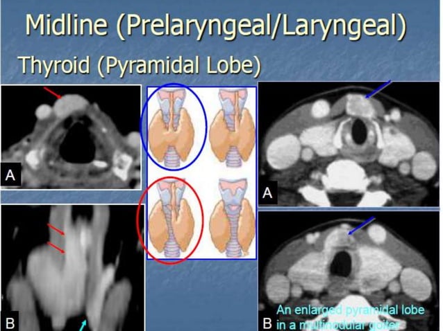 Presentation1.pptx, radiological imaging of adult neck masses. | PPTX ...