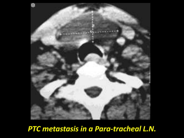 Presentation1.pptx, radiological imaging of adult neck masses. | PPTX ...