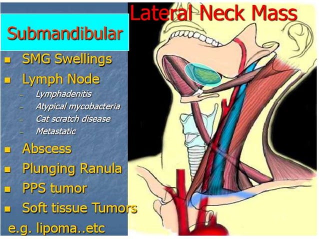 Presentation1.pptx, radiological imaging of adult neck masses. | PPTX ...