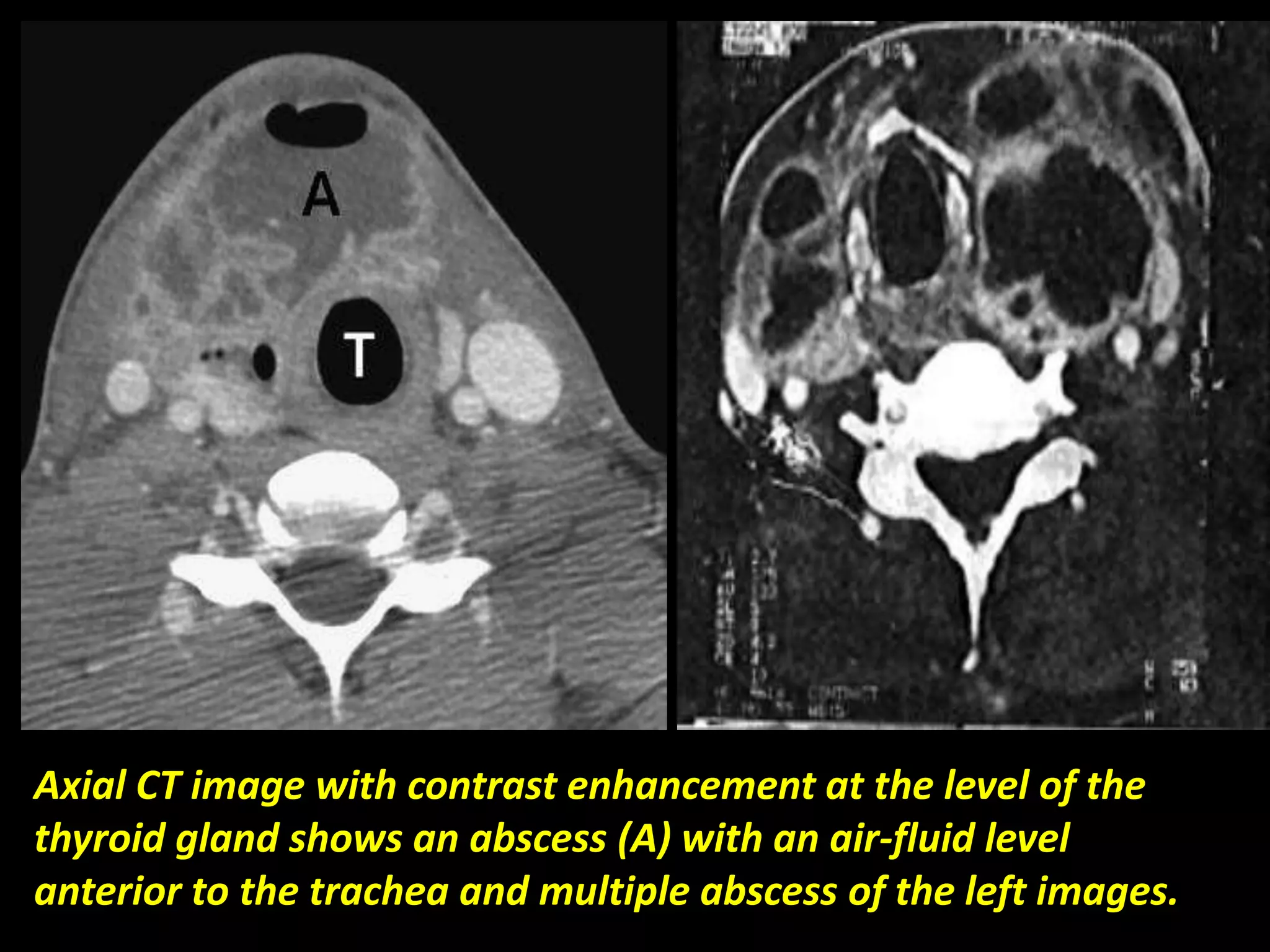 Presentation1.pptx, radiological imaging of the thyroid gland diseases ...