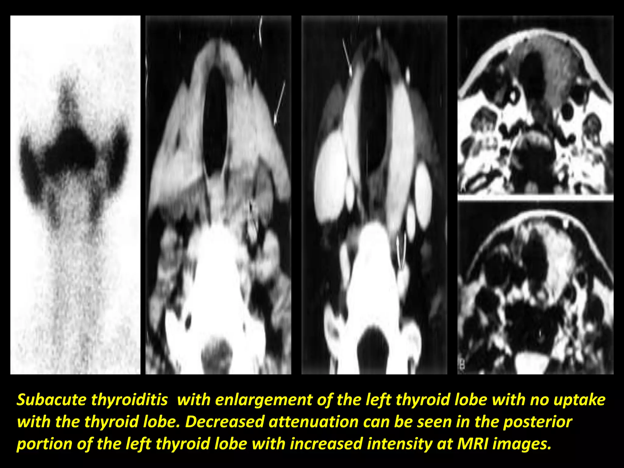 Presentation1.pptx, radiological imaging of the thyroid gland diseases ...