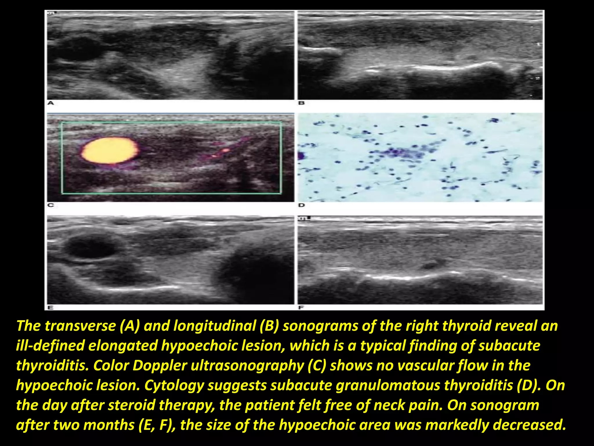 Presentation1.pptx, radiological imaging of the thyroid gland diseases ...