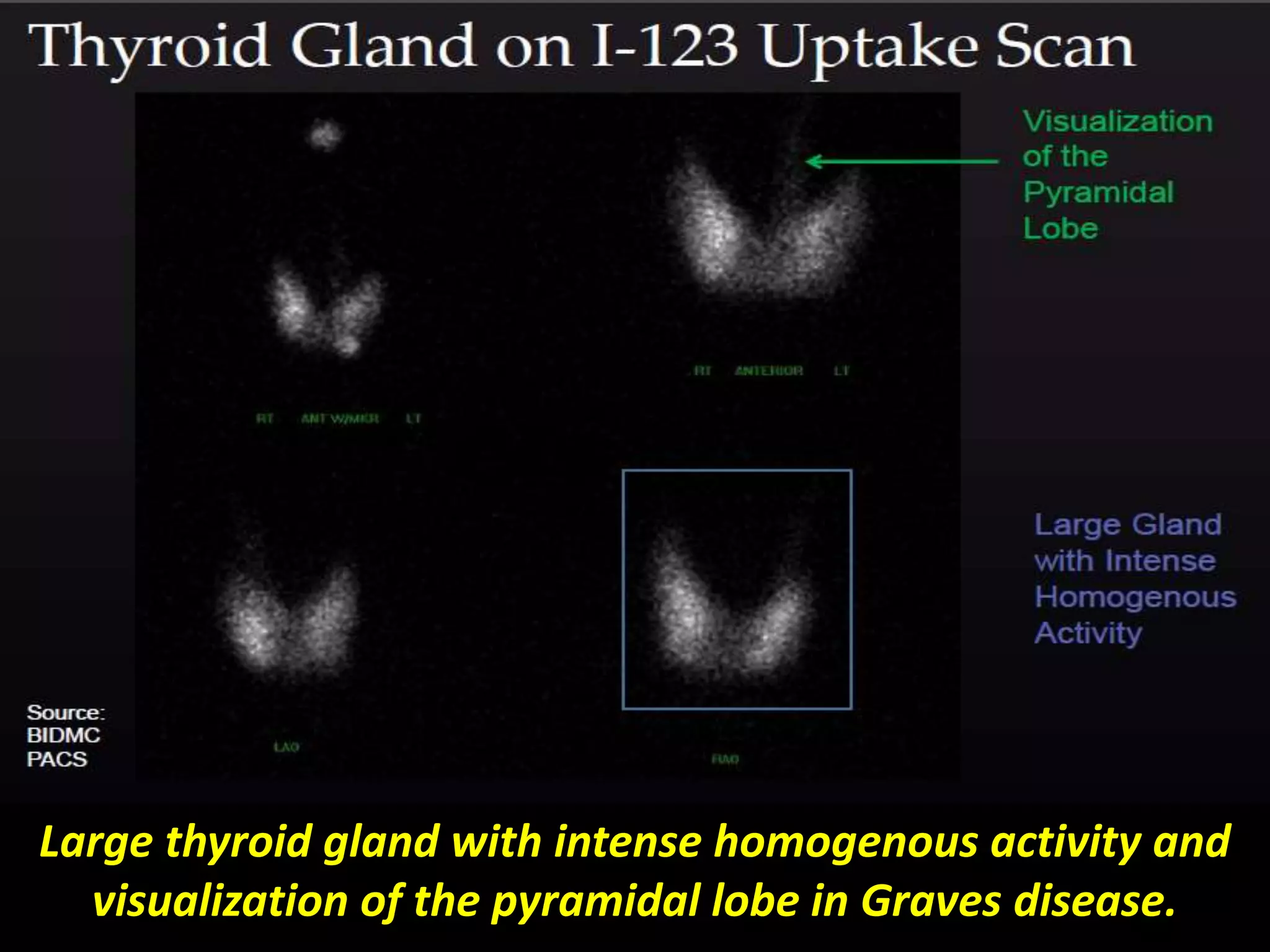 Presentation1.pptx, radiological imaging of the thyroid gland diseases ...