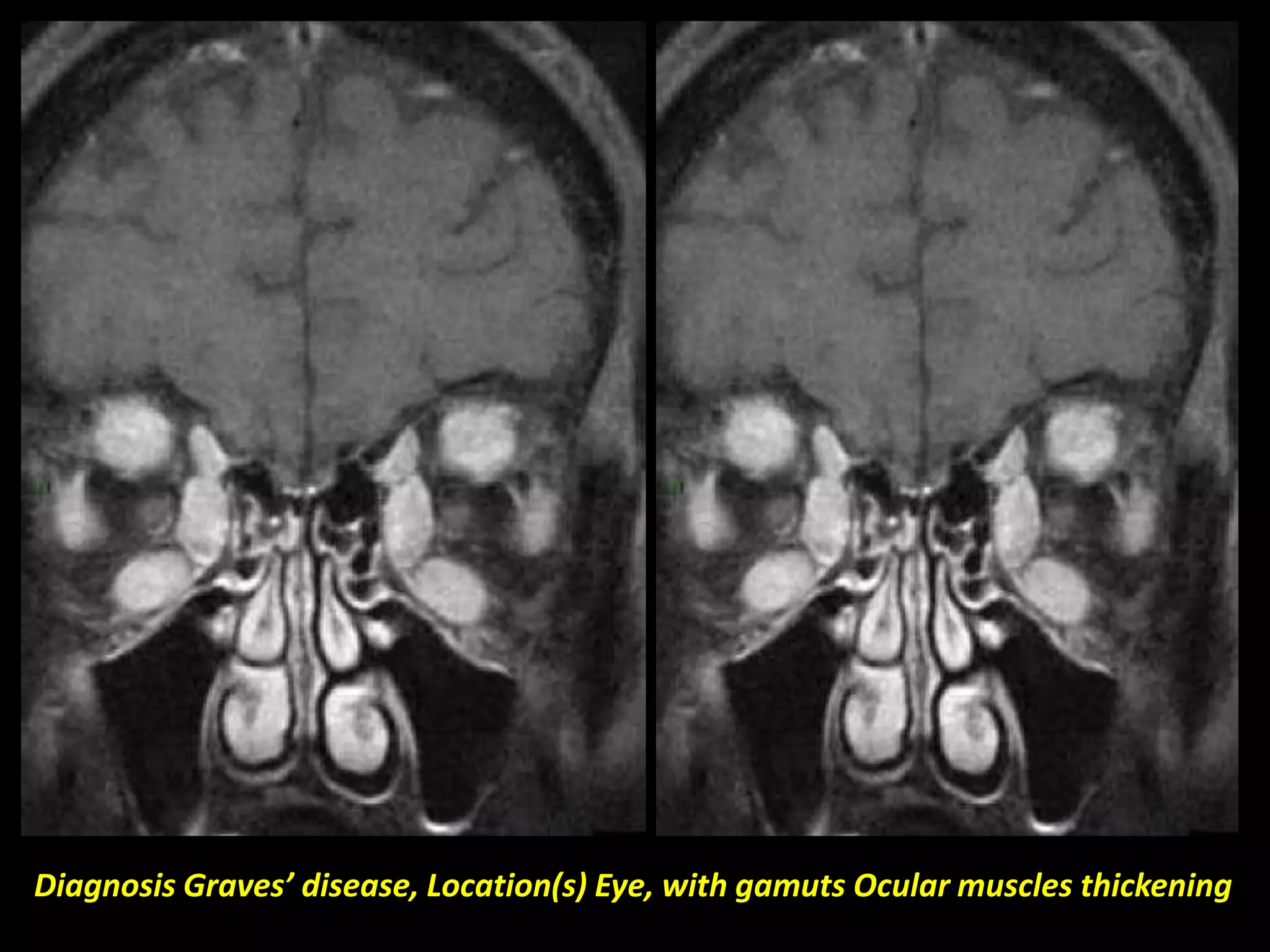 Presentation1.pptx, radiological imaging of the thyroid gland diseases ...