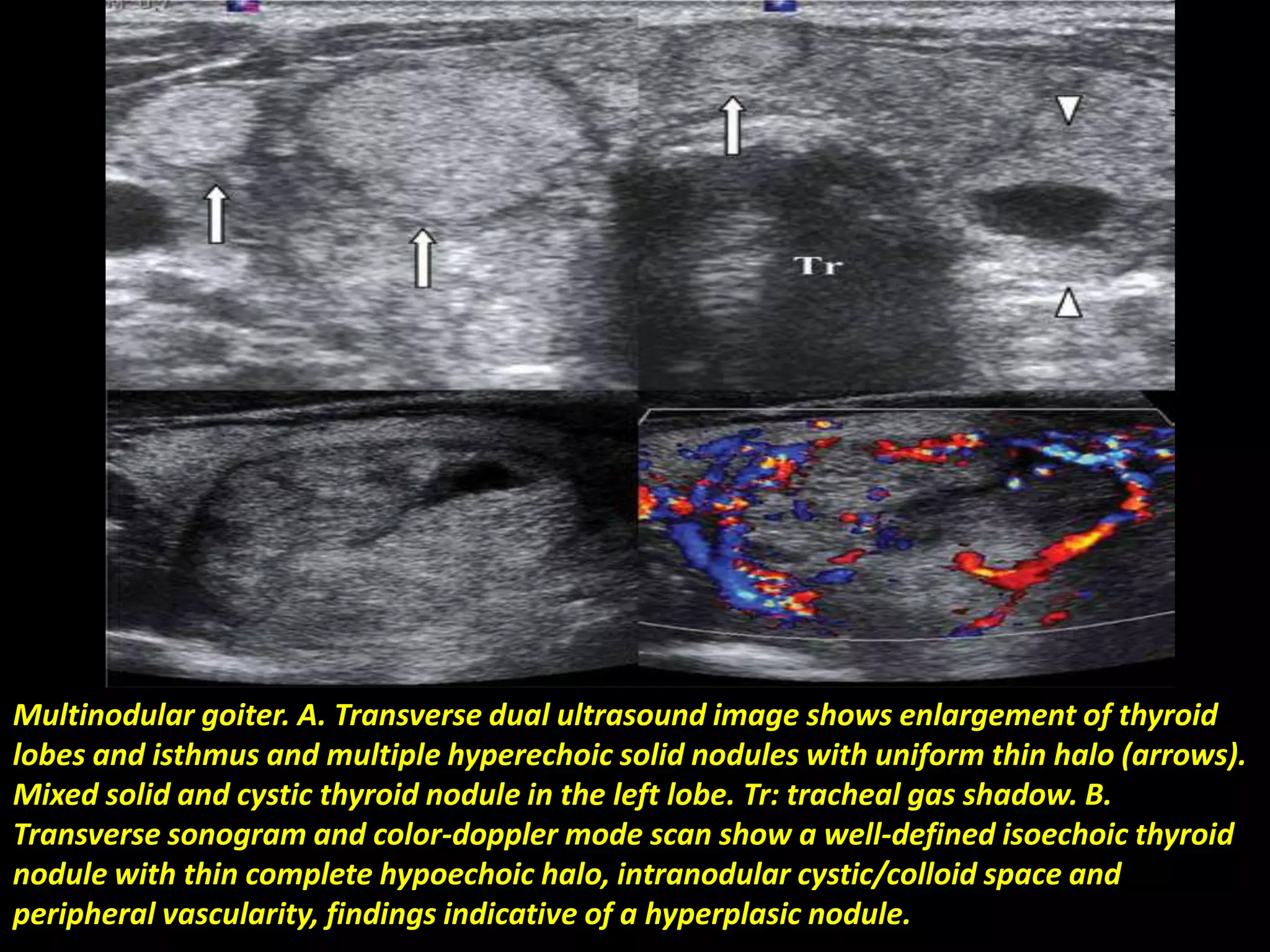 Presentation1.pptx, radiological imaging of the thyroid gland diseases ...