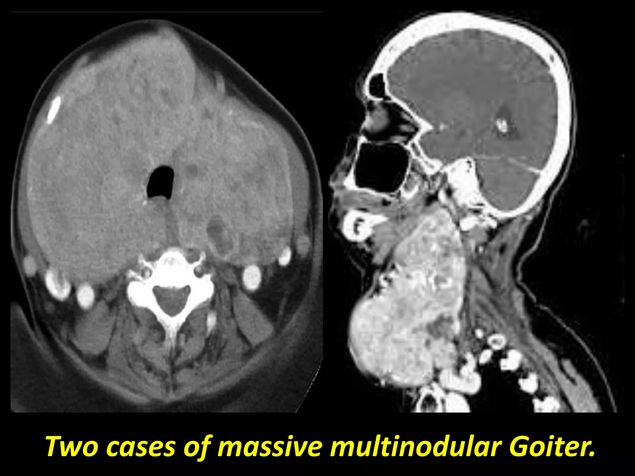 Presentation1.pptx, radiological imaging of the thyroid gland diseases ...