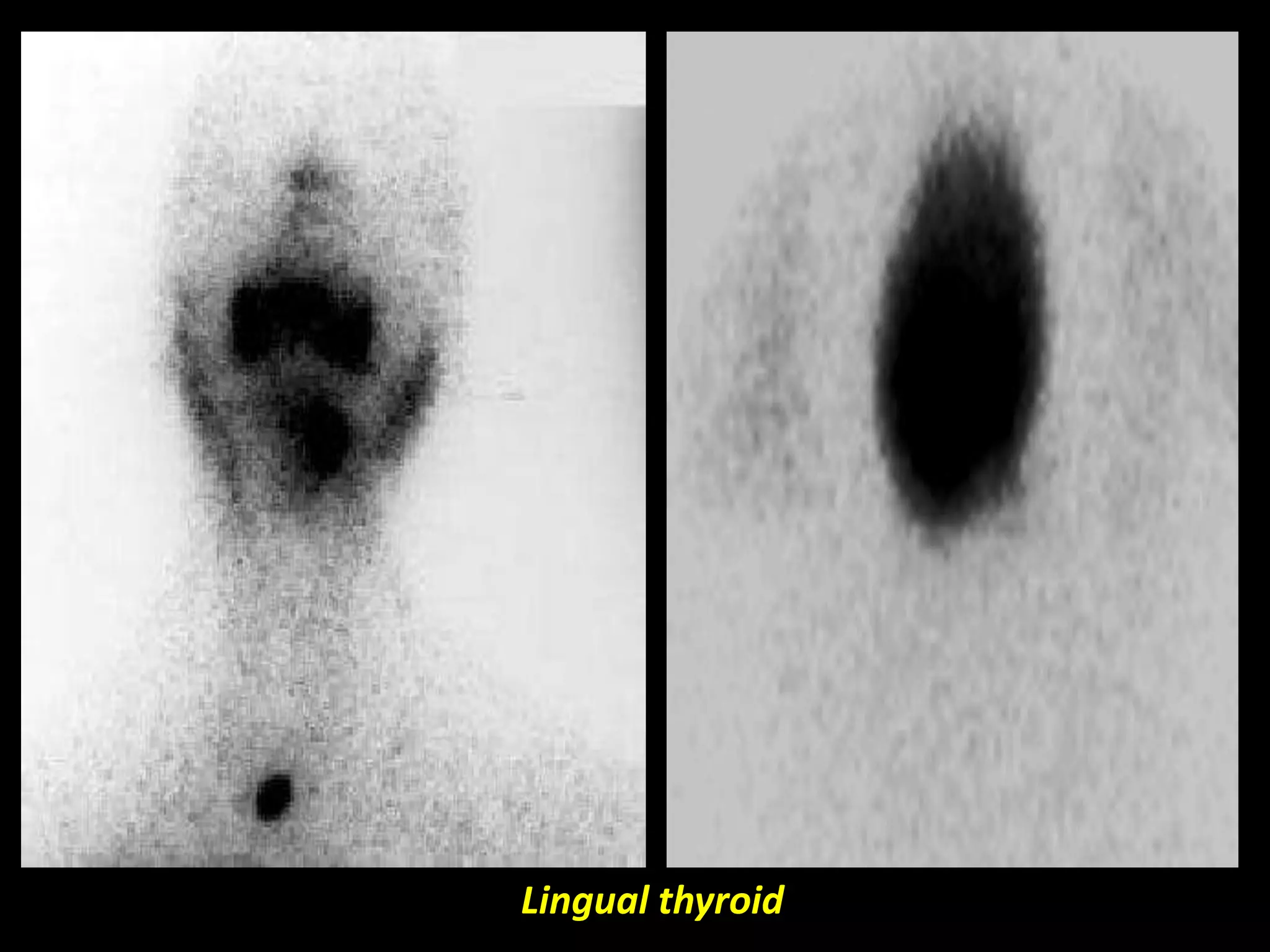Presentation1.pptx, radiological imaging of the thyroid gland diseases ...