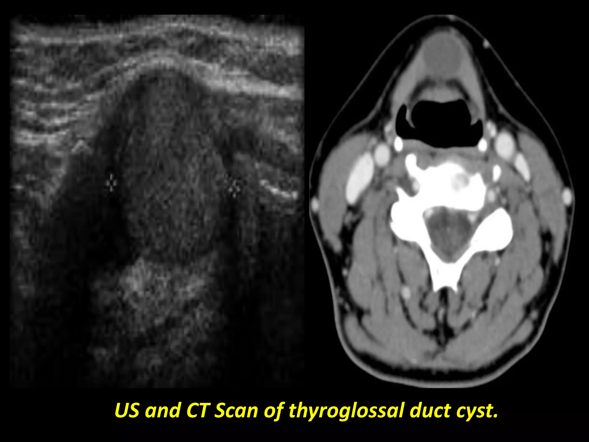 Presentation1.pptx, radiological imaging of the thyroid gland diseases ...