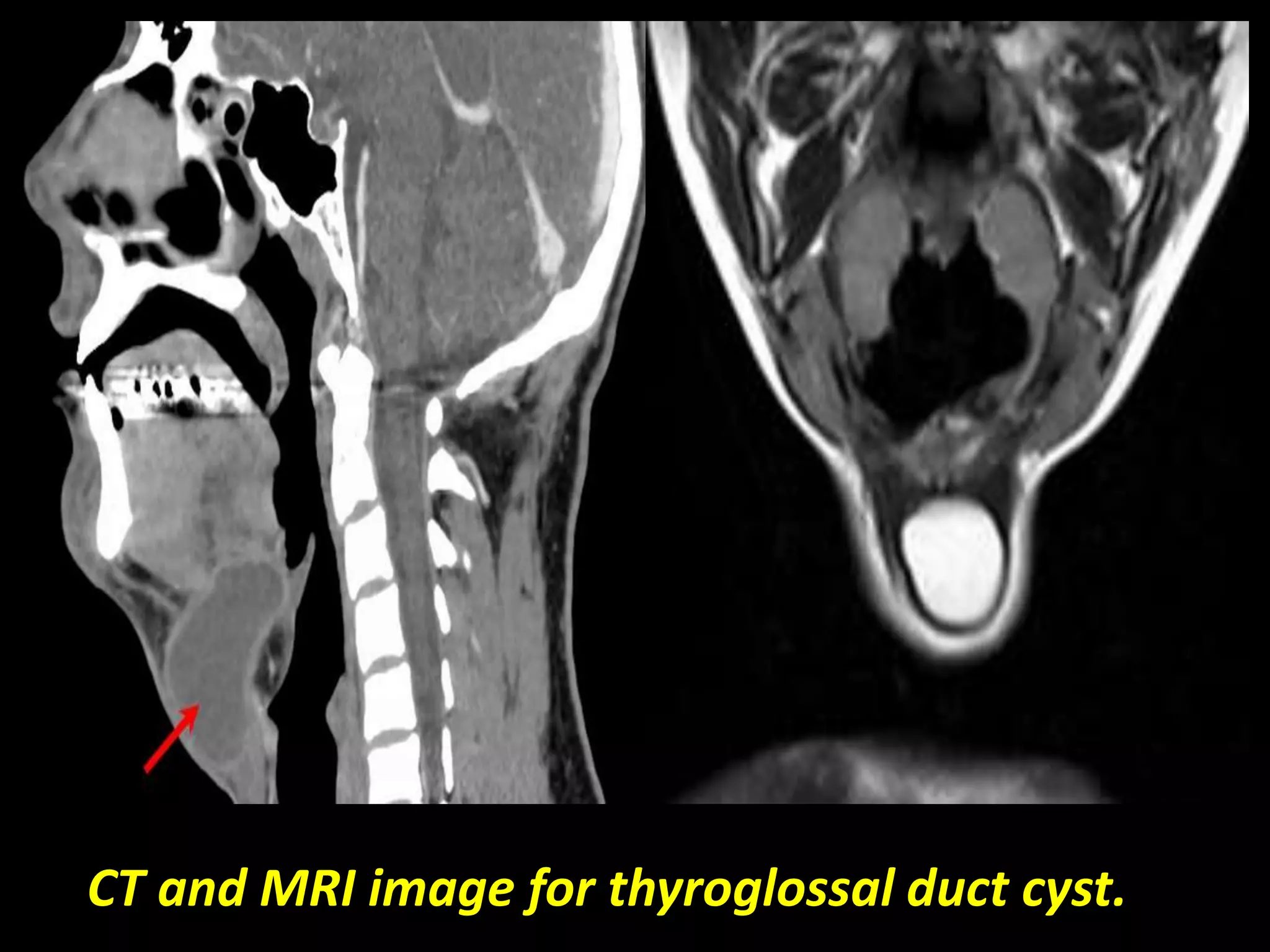 Presentation1.pptx, radiological imaging of the thyroid gland diseases ...