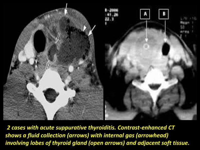 Presentation1.pptx, radiological imaging of the thyroid gland diseases ...