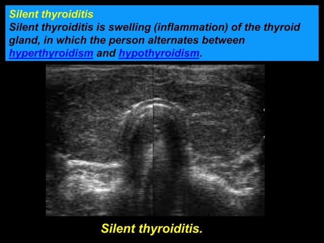 Presentation1.pptx, radiological imaging of the thyroid gland diseases ...