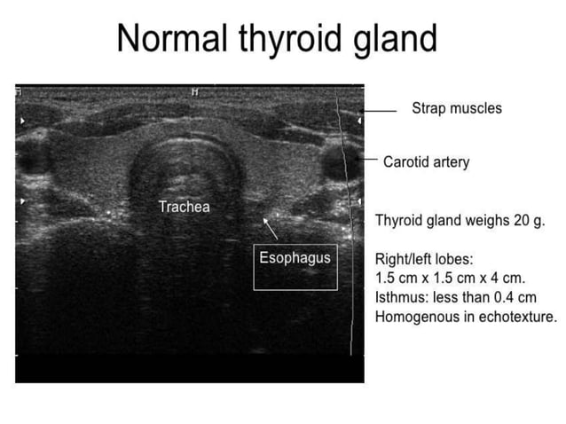 Presentation1.pptx, radiological imaging of the thyroid gland diseases ...