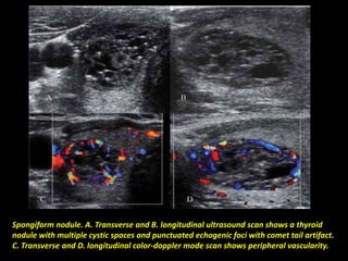 Presentation1.pptx, radiological imaging of the thyroid gland diseases ...
