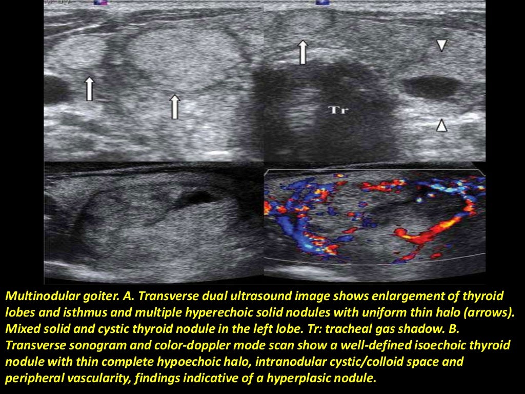 Presentation1.pptx, radiological imaging of the thyroid gland disease…