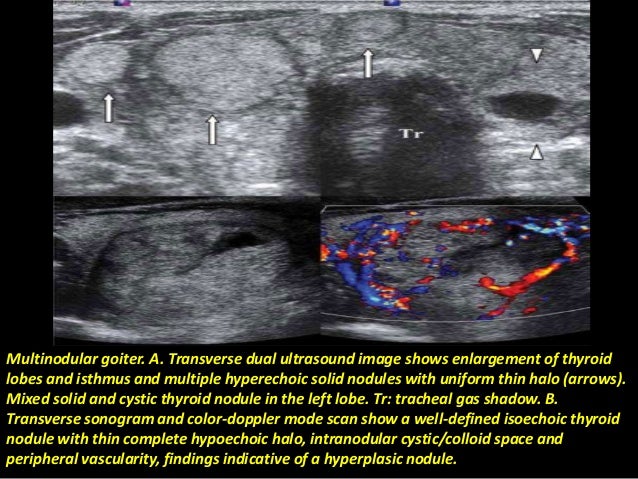 Isoechoic Thyroid Nodule