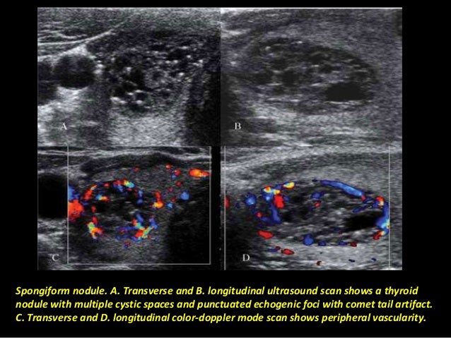 Presentation1.pptx, radiological imaging of the thyroid gland disease…