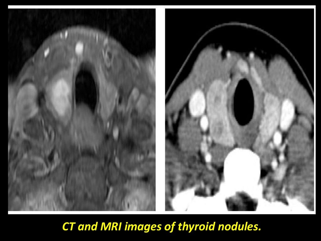 Presentation1.pptx, radiological imaging of the thyroid gland disease…