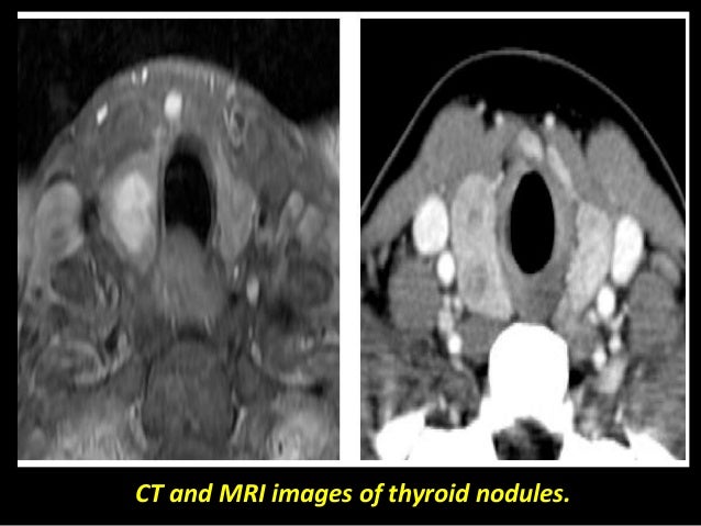 Presentation1.pptx, radiological imaging of the thyroid gland disease…