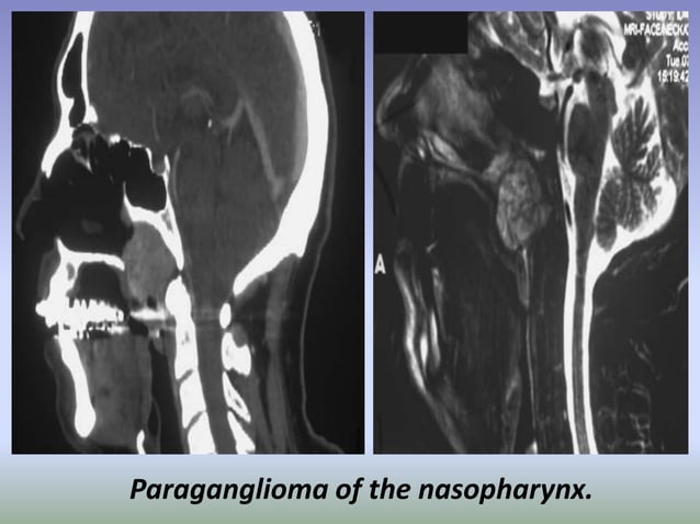 Presentation1.pptx, radiological imaging of the nasopharyngeal diseases ...