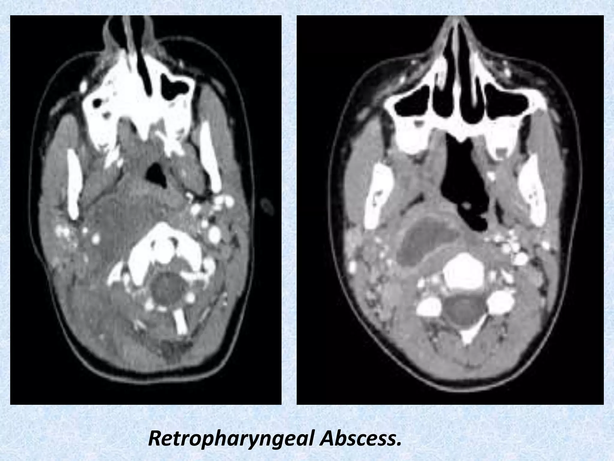 Presentation1.pptx, radiological imaging of the pharyngeal diseases | PPTX