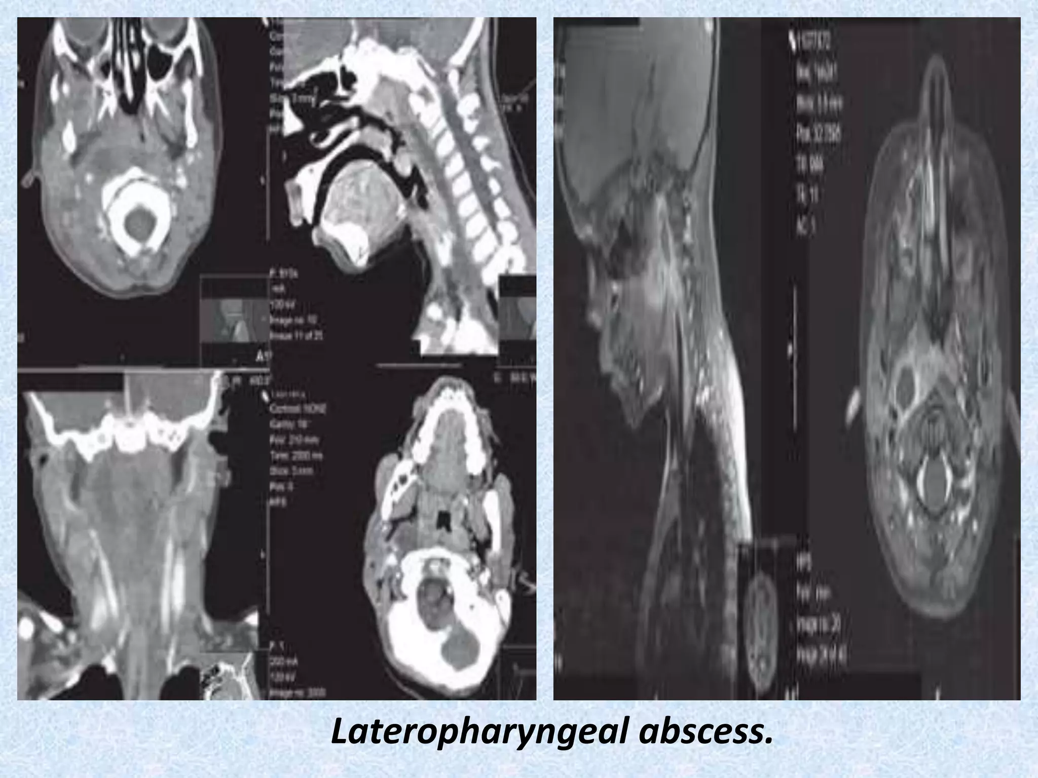 Presentation1.pptx, radiological imaging of the pharyngeal diseases | PPTX