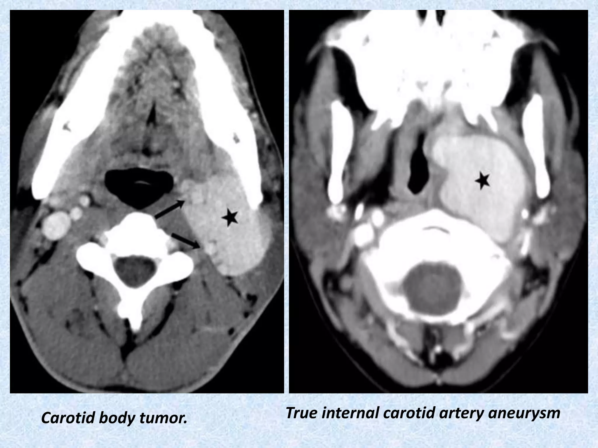 Presentation1.pptx, radiological imaging of the pharyngeal diseases | PPTX