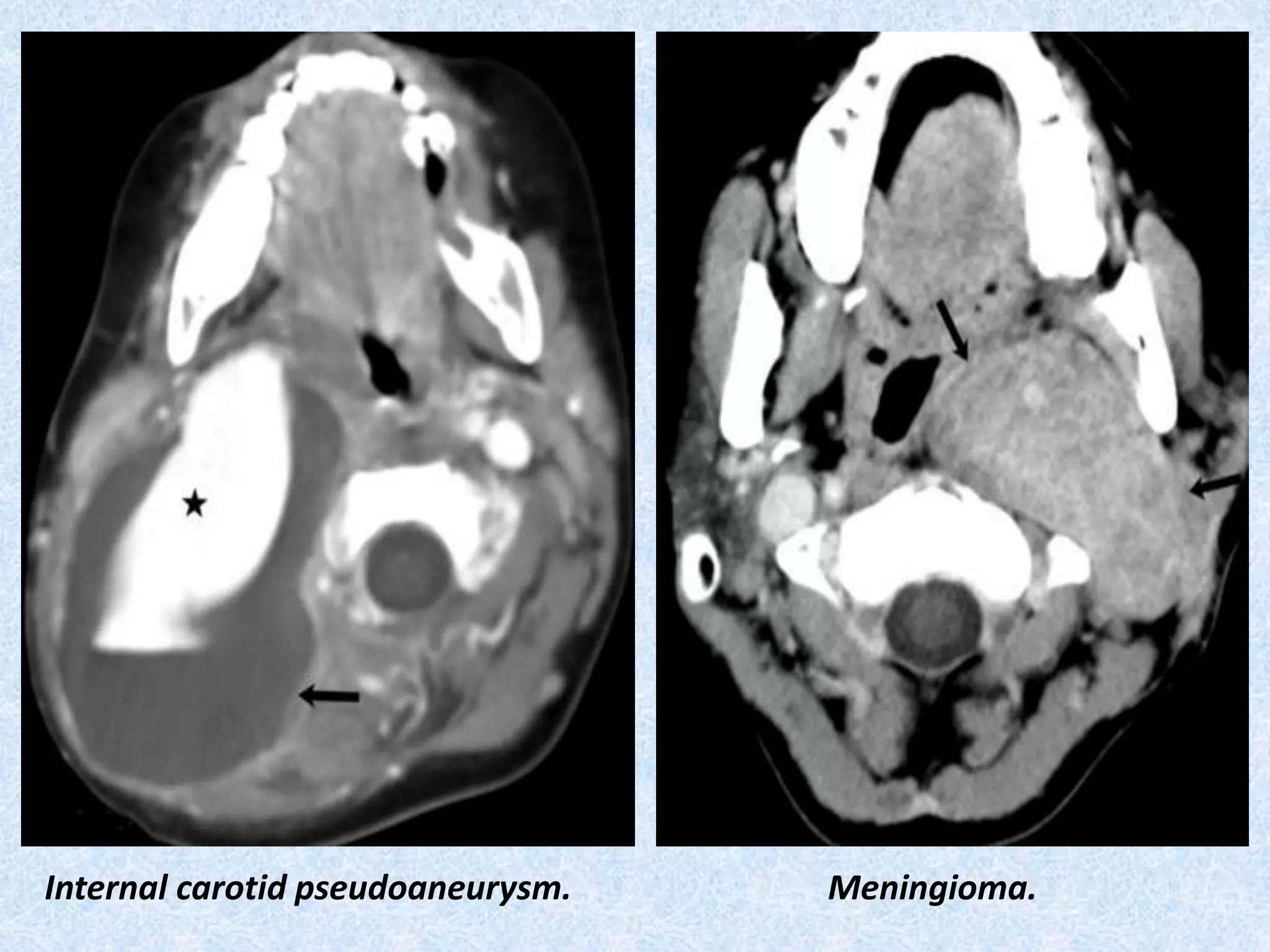 Presentation1.pptx, radiological imaging of the pharyngeal diseases | PPTX