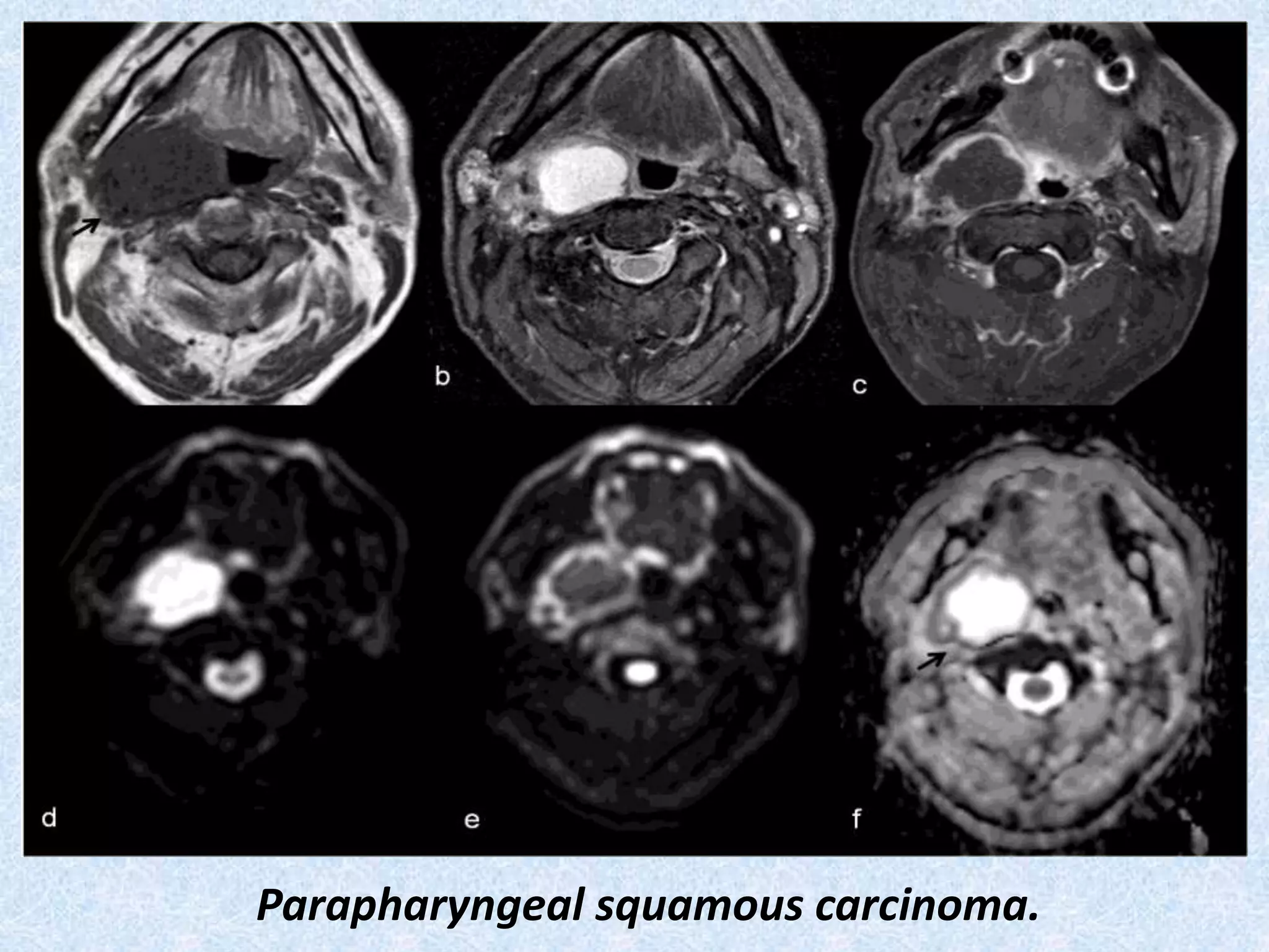 Presentation1.pptx, radiological imaging of the pharyngeal diseases | PPTX