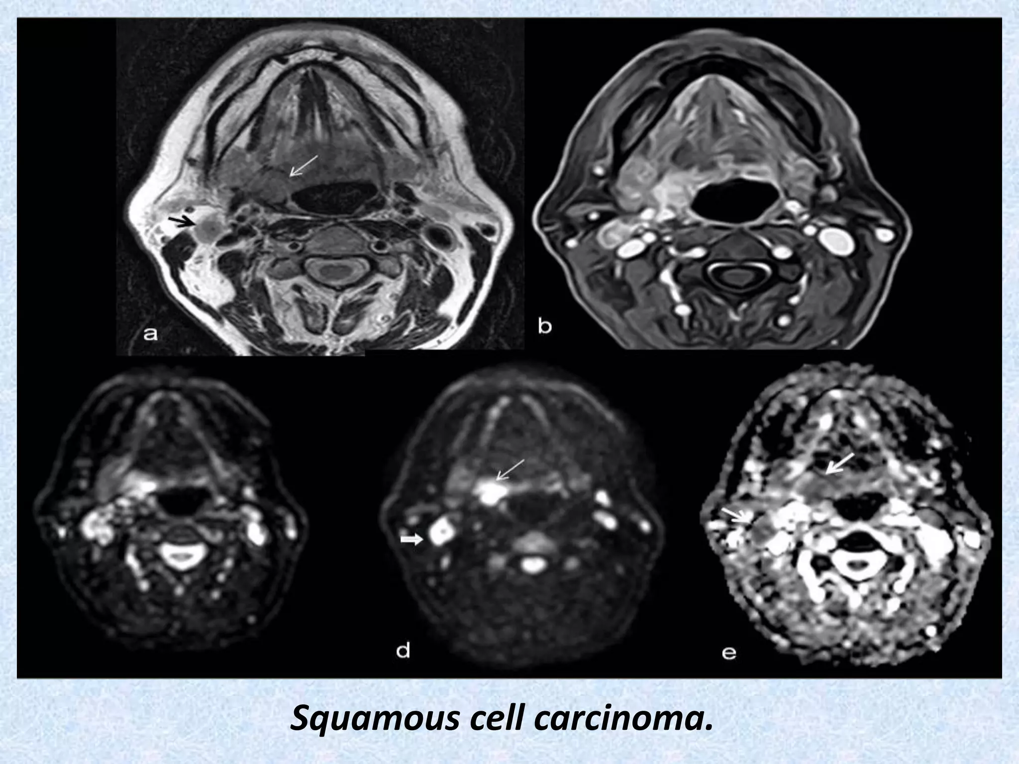 Presentation1.pptx, radiological imaging of the pharyngeal diseases | PPTX
