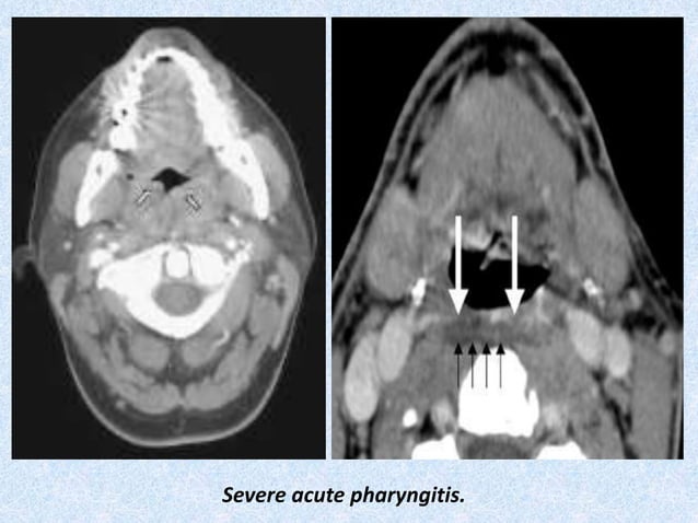 Presentation1.pptx, radiological imaging of the pharyngeal diseases ...