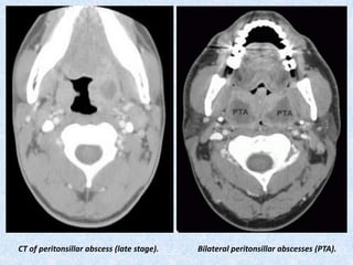 Presentation1.pptx, radiological imaging of the pharyngeal diseases | PPTX
