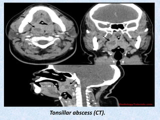 Presentation1.pptx, radiological imaging of the pharyngeal diseases | PPTX