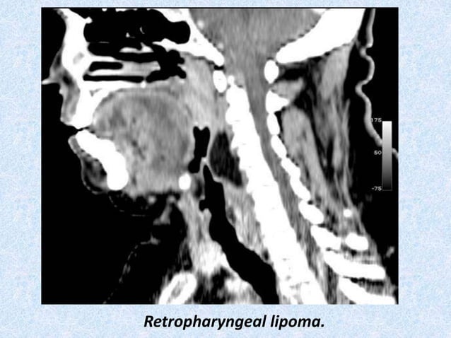 Presentation1.pptx, radiological imaging of the pharyngeal diseases ...
