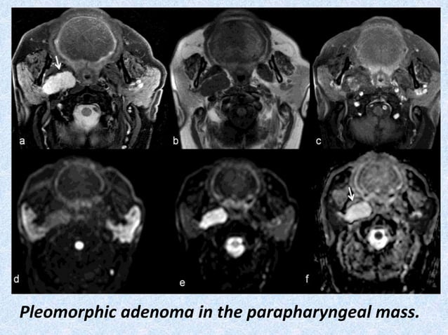 Presentation1.pptx, radiological imaging of the pharyngeal diseases ...