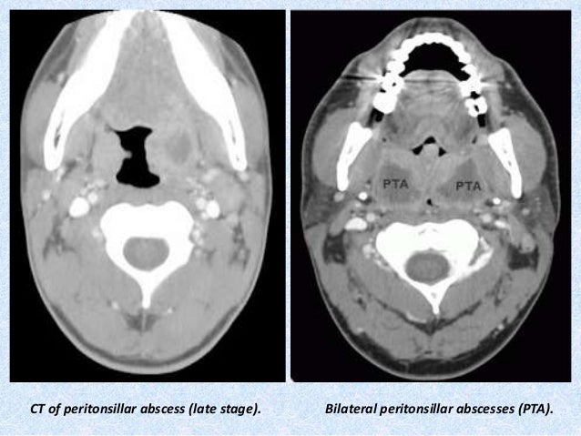 Presentation1.pptx, radiological imaging of the pharyngeal diseases