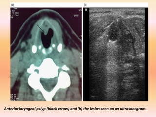 Presentation1.pptx, radiological imaging of the larngeal diseases. | PPTX