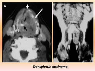 Presentation1.pptx, radiological imaging of the larngeal diseases. | PPTX