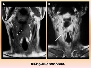 Presentation1.pptx, radiological imaging of the larngeal diseases. | PPTX
