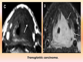 Presentation1.pptx, radiological imaging of the larngeal diseases. | PPTX