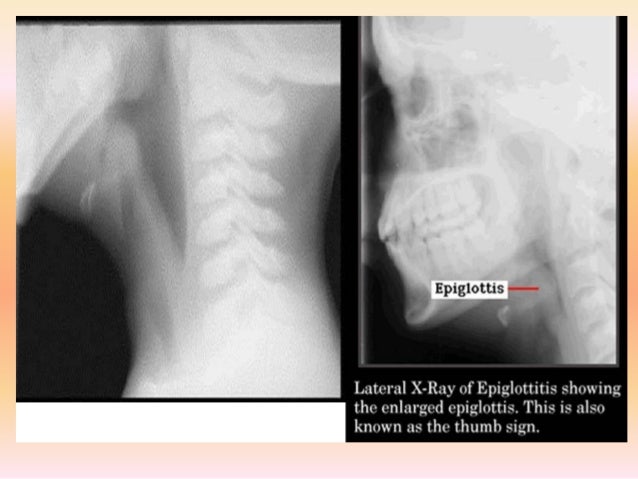 Laryngitis X Ray