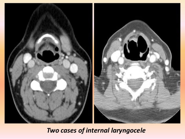 Presentation1.pptx, radiological imaging of the larngeal diseases.