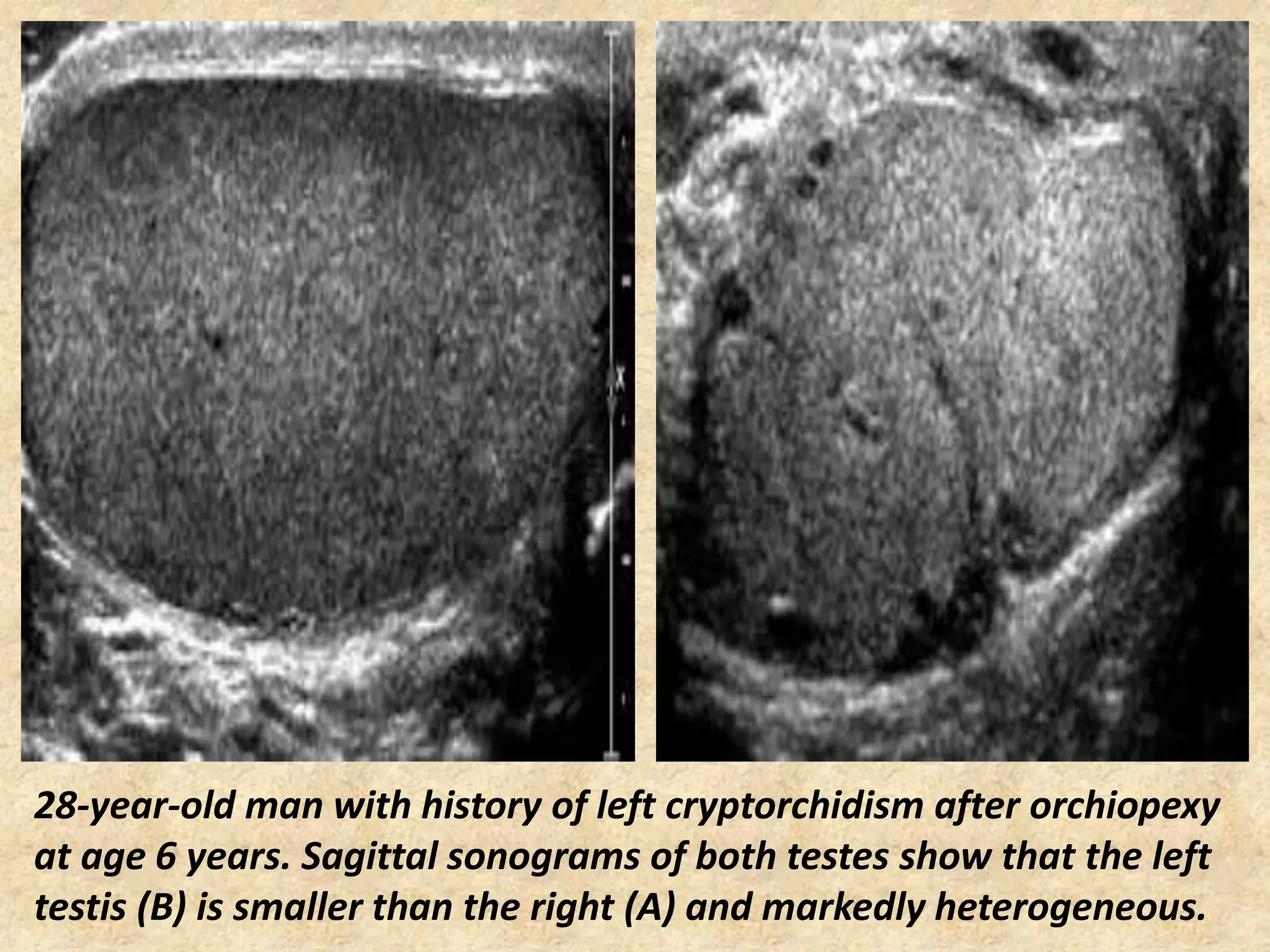 Presentation1.pptx, radiological imaging of male infertility. | PPTX