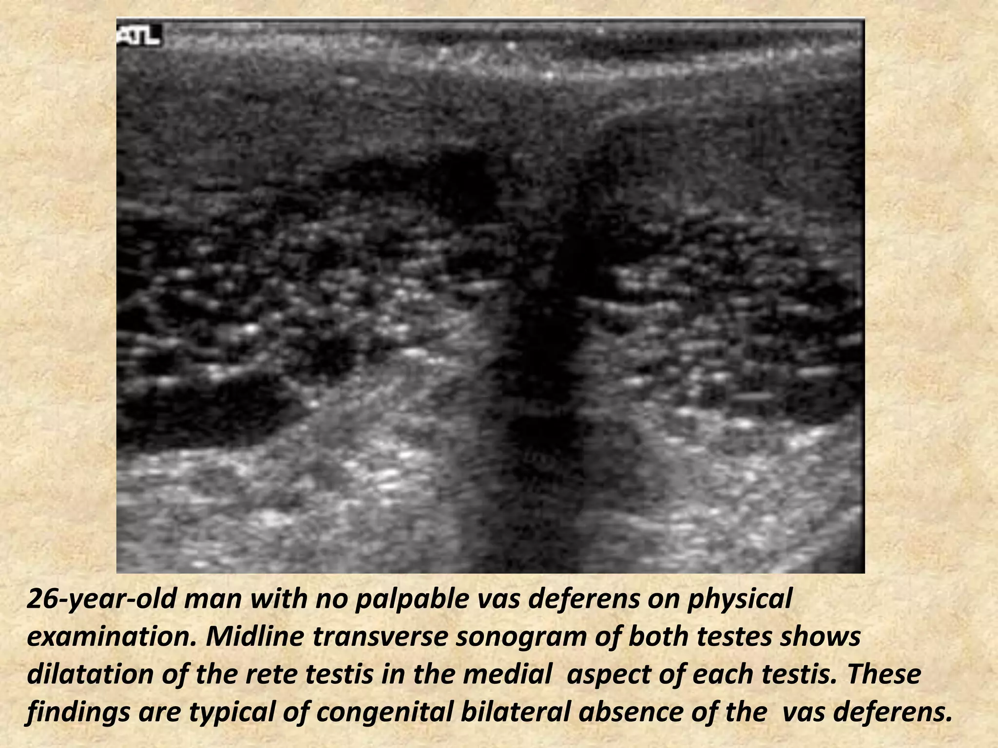 Presentation1.pptx, radiological imaging of male infertility. | PPTX