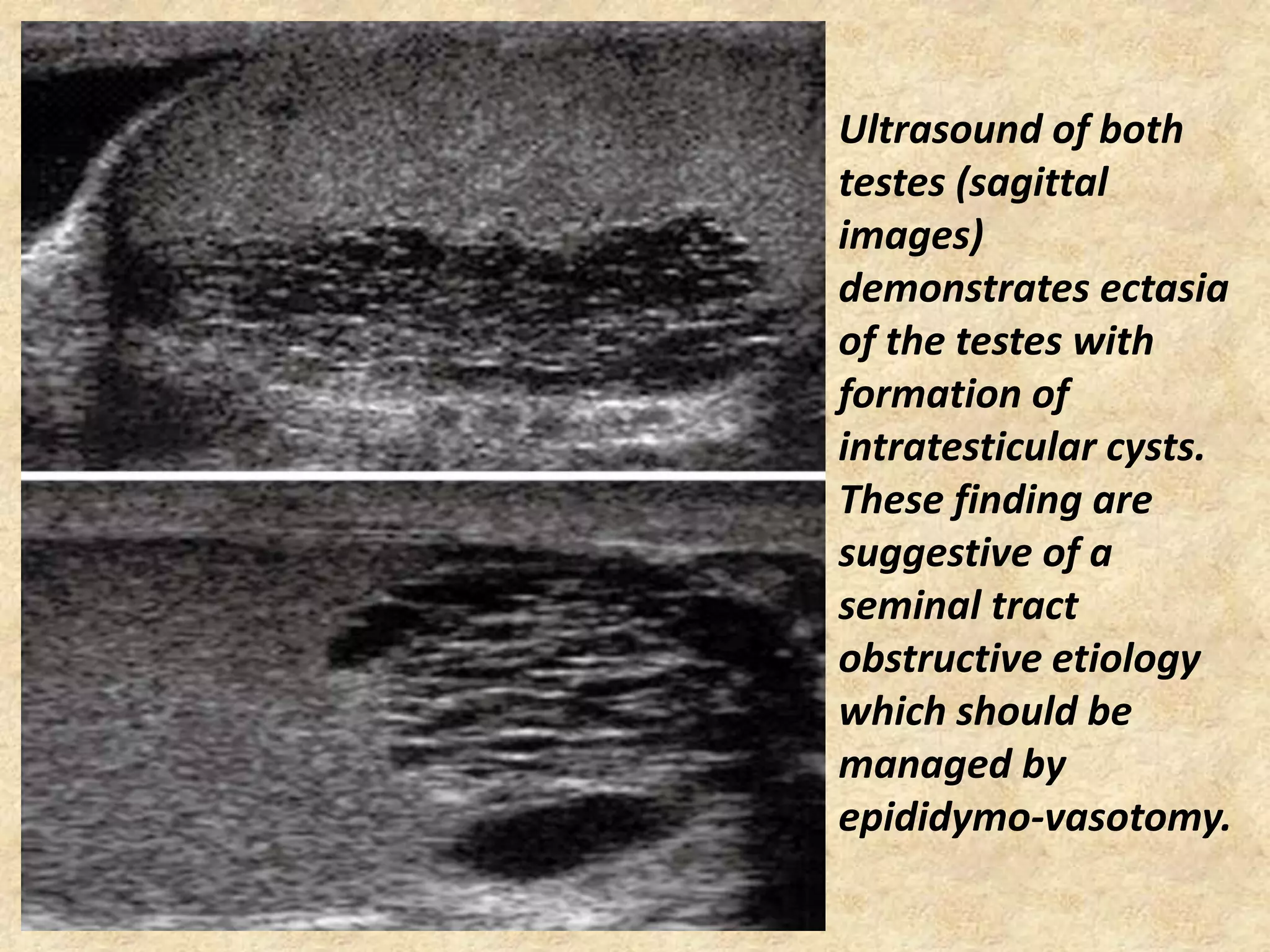 Presentation1.pptx, radiological imaging of male infertility. | PPTX