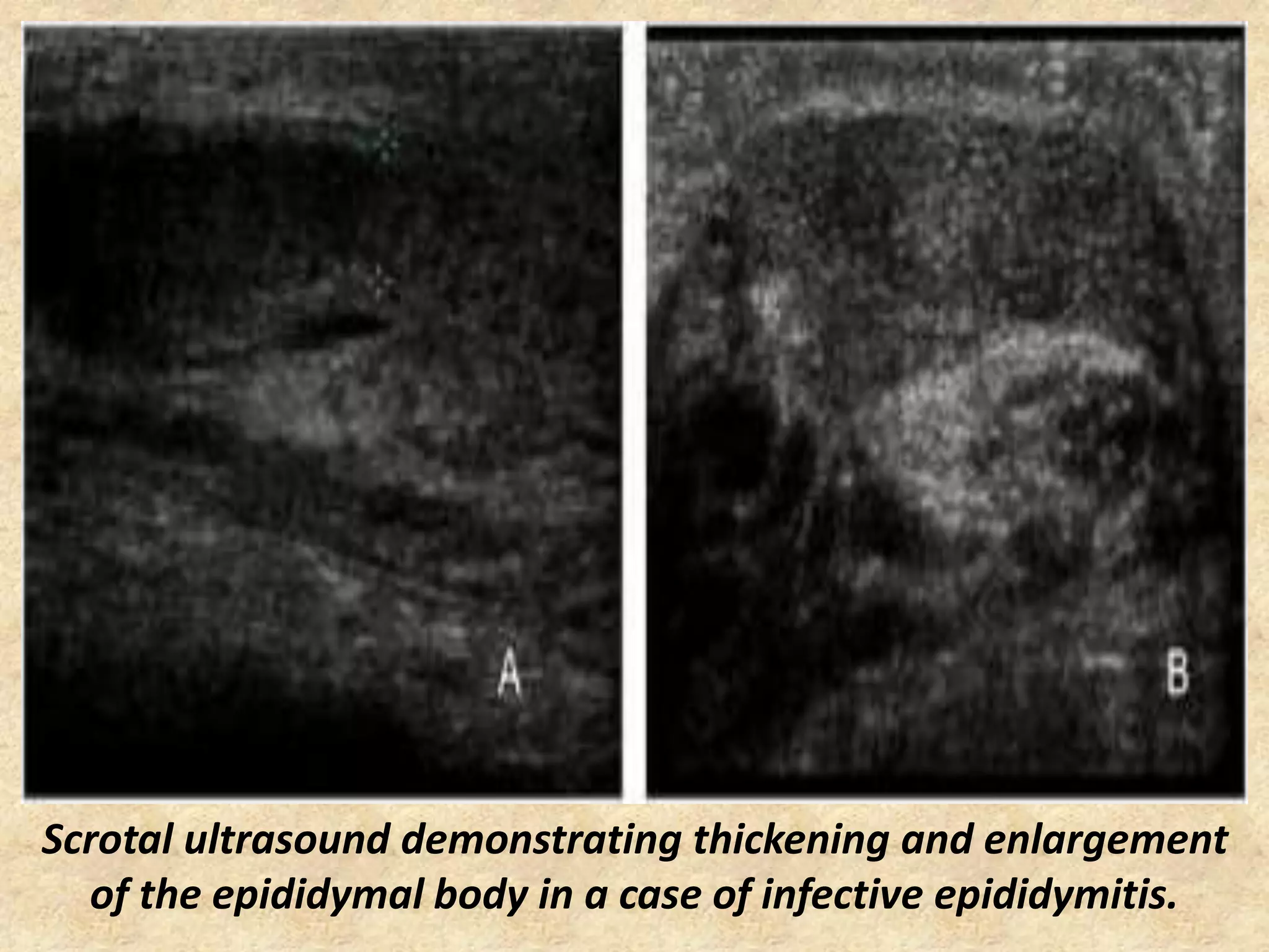 Presentation1.pptx, radiological imaging of male infertility. | PPTX