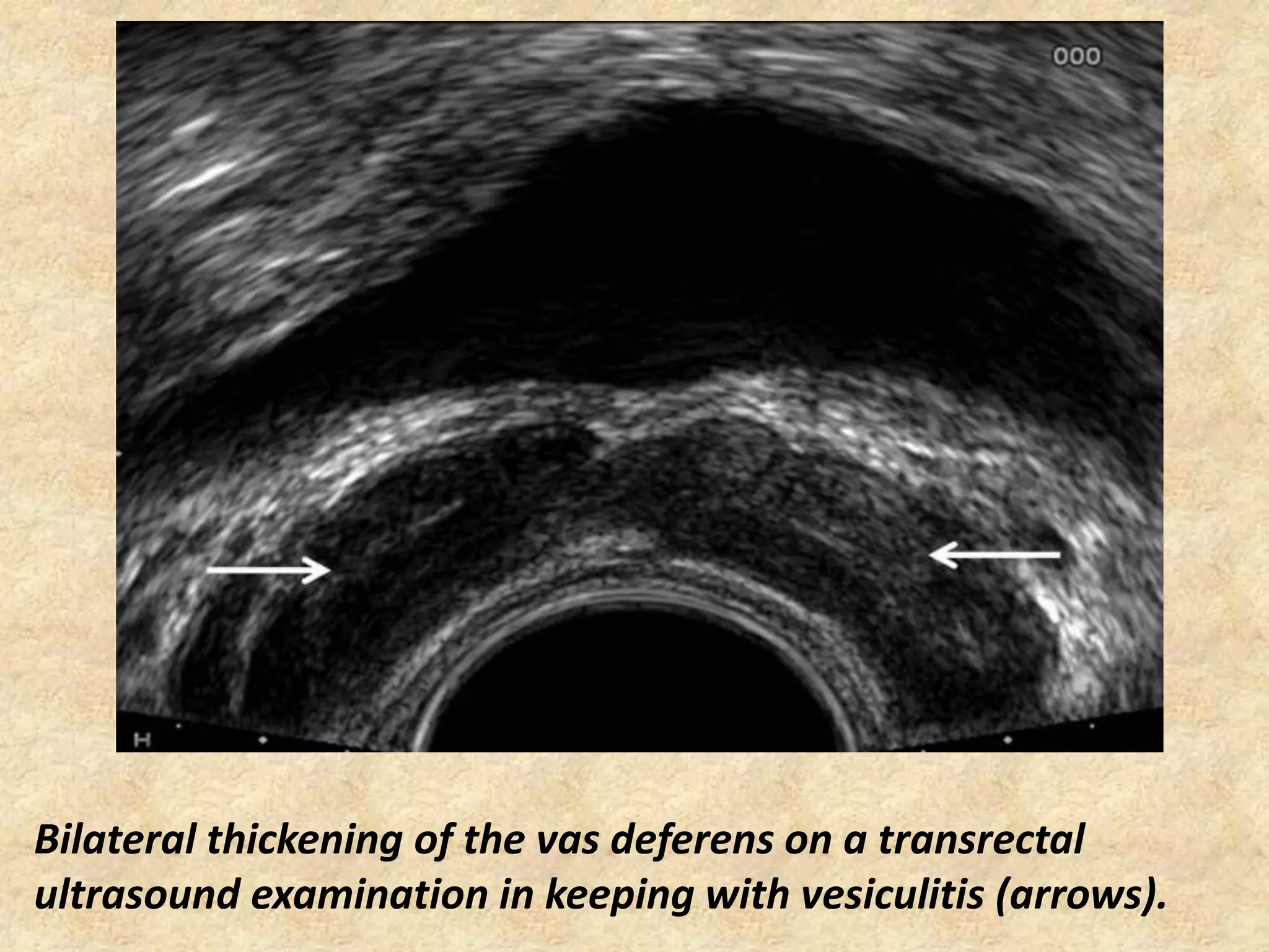 Presentation1.pptx, radiological imaging of male infertility. | PPTX