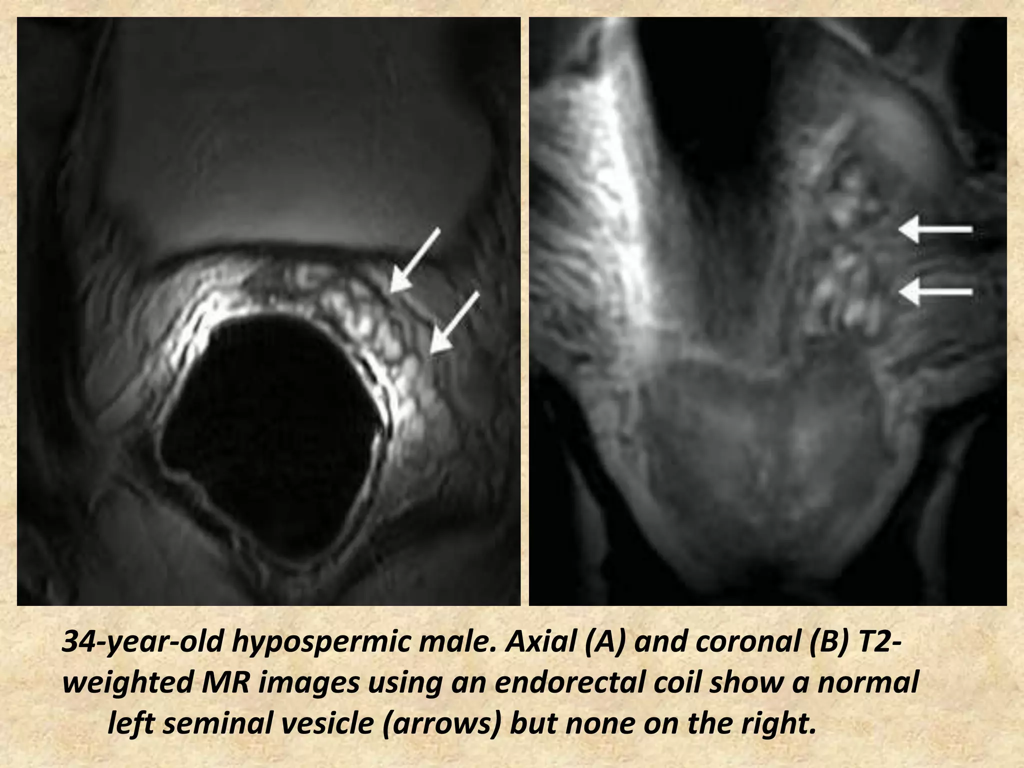 Presentation1.pptx, radiological imaging of male infertility. | PPTX